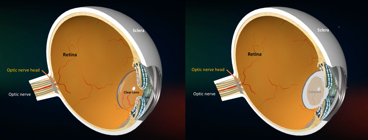Glaucoma Information Is glaucoma associated with cataract - Glaucoma ... Glaucoma Information Is glaucoma associated with cataract - Glaucoma ...