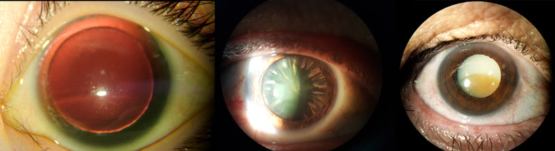 Glaucoma Information Is glaucoma associated with cataract - Glaucoma ... Glaucoma Information Is glaucoma associated with cataract - Glaucoma ...